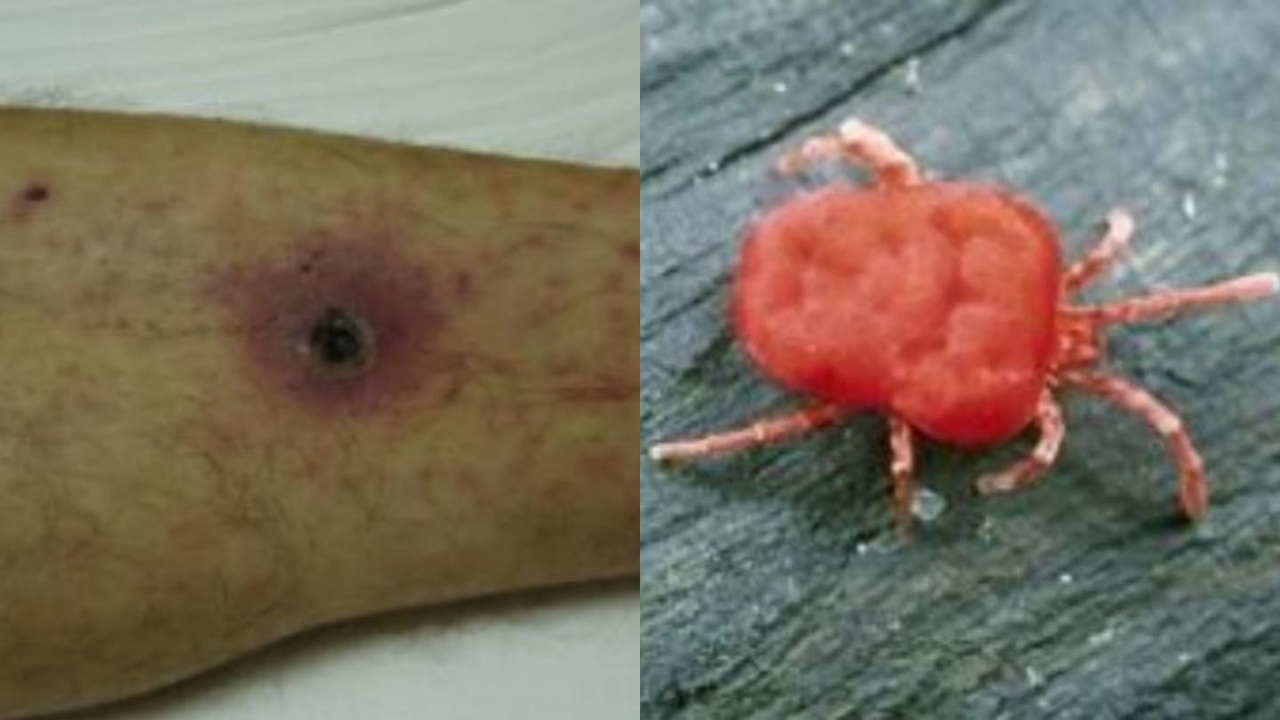 Alerta Epidemiológica en Los Lagos por "tifus de los matorrales ...